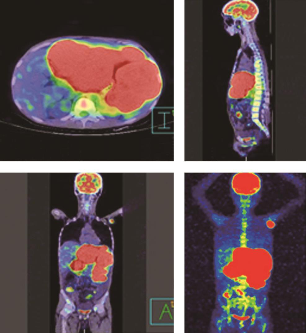 克罗恩病合并淋巴瘤1例诊治解析—优医迈病例参考